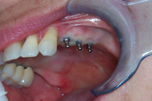 Thin Ridge Implant Placement | Shatkin F.I.R.S.T.